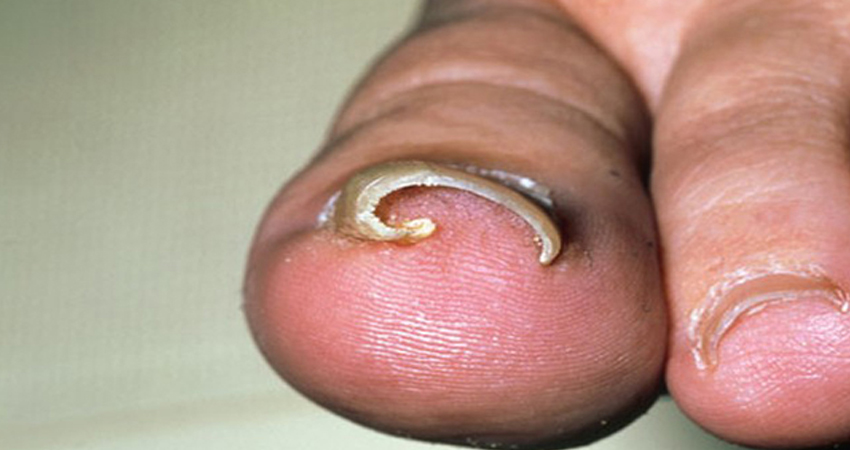 وسیله درآوردن ناخن از گوشت | دانشنامه سیب